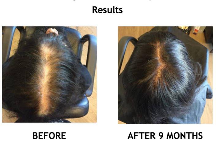 UP Hair Growth System stops hair loss & creates fast new growth