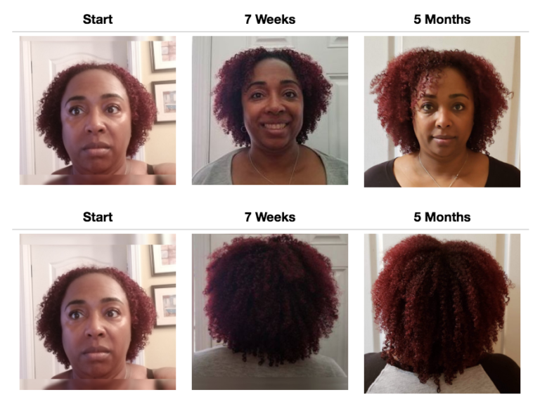 UP Hair Growth System stops hair loss & creates fast new growth