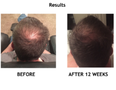 GroUP "Step-1" Shampoo - UP Hair Growth System